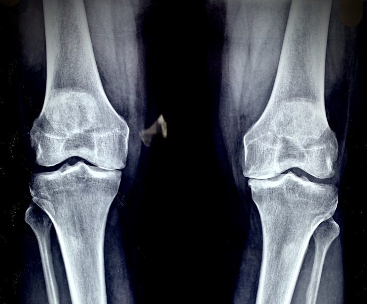 Knee Arthritis - Dr Abhishek Nerurkar